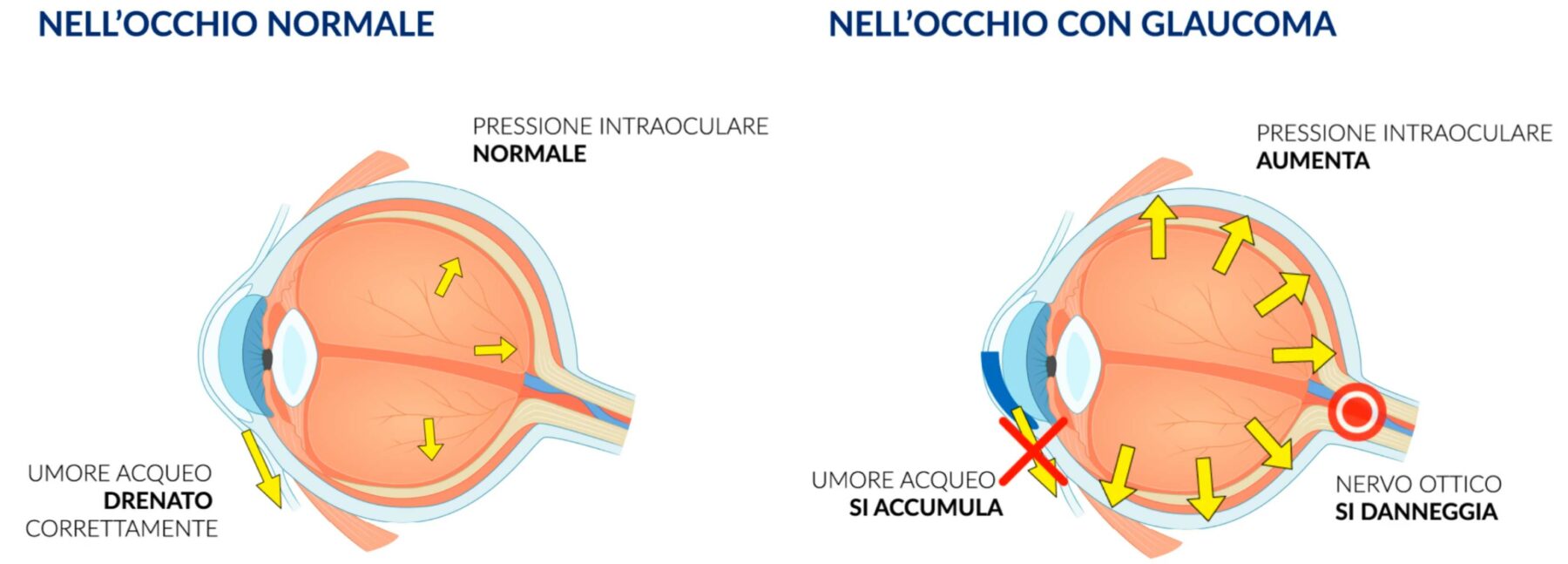IL GLAUCOMA - Ottica Capello