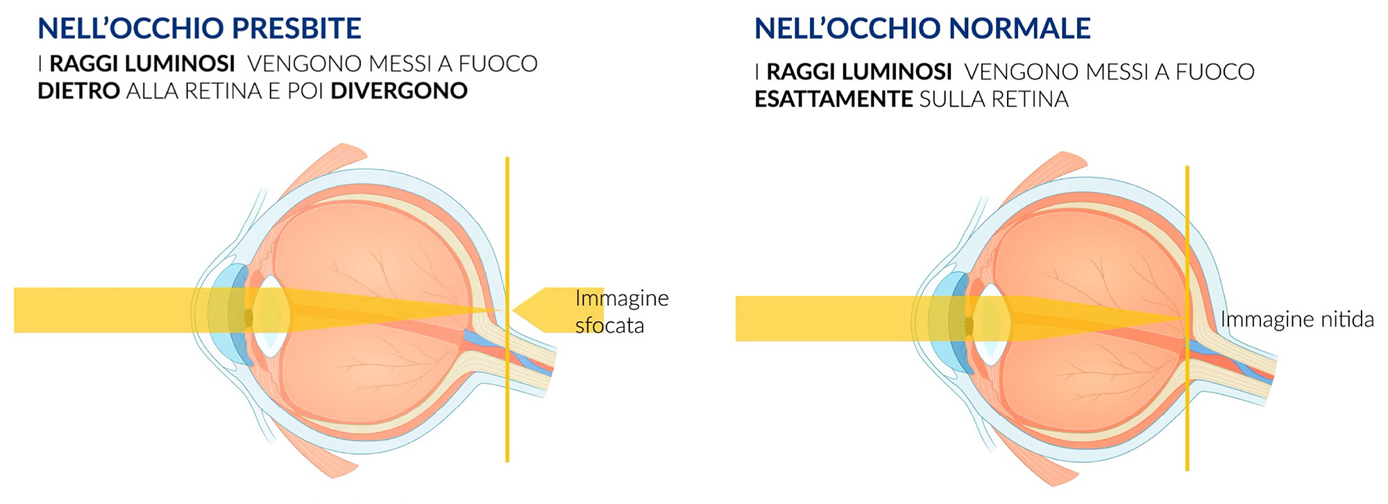 LA PRESBIOPIA - Ottica Capello